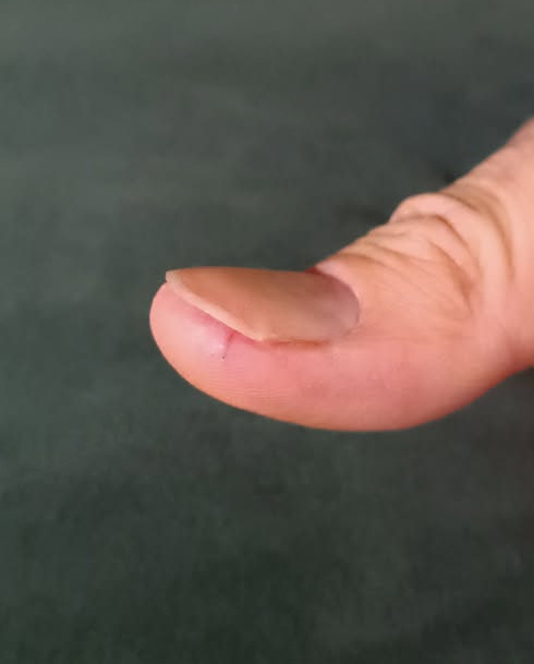 Cracked Skin On Fingertips - Simply and Naturally